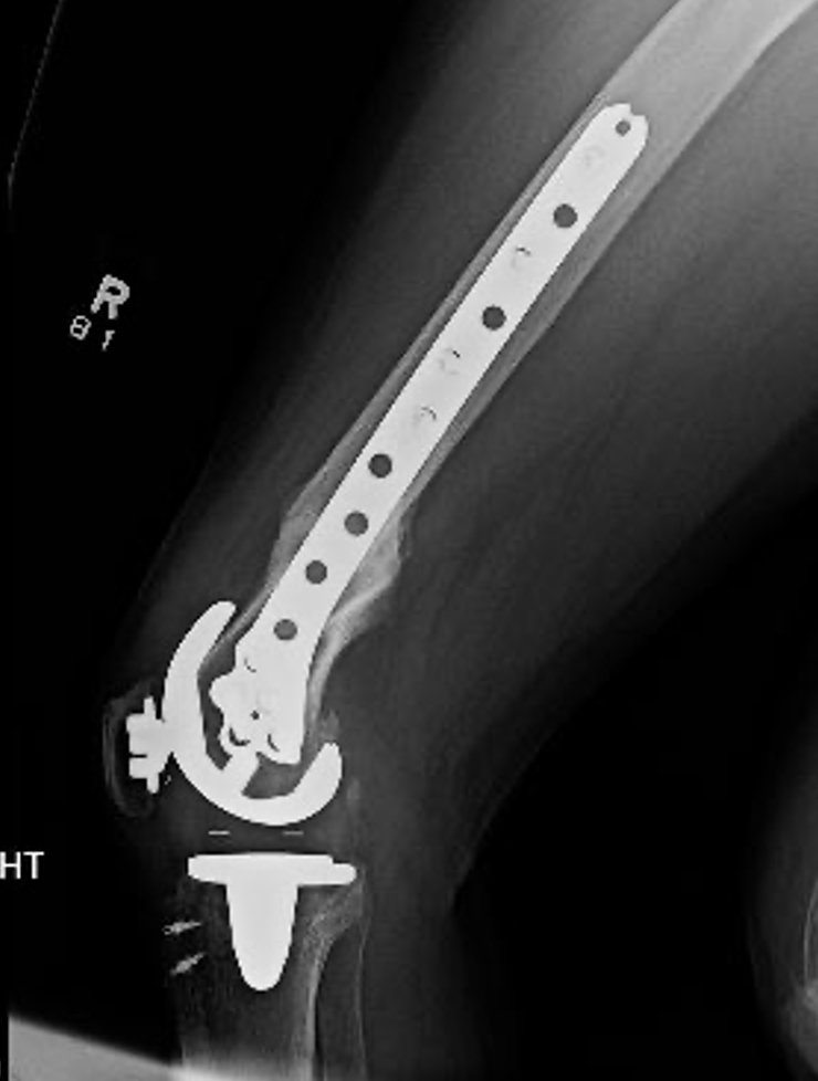 Early Weight Bearing after Distal Femur Fractures in the Elderly: A ...