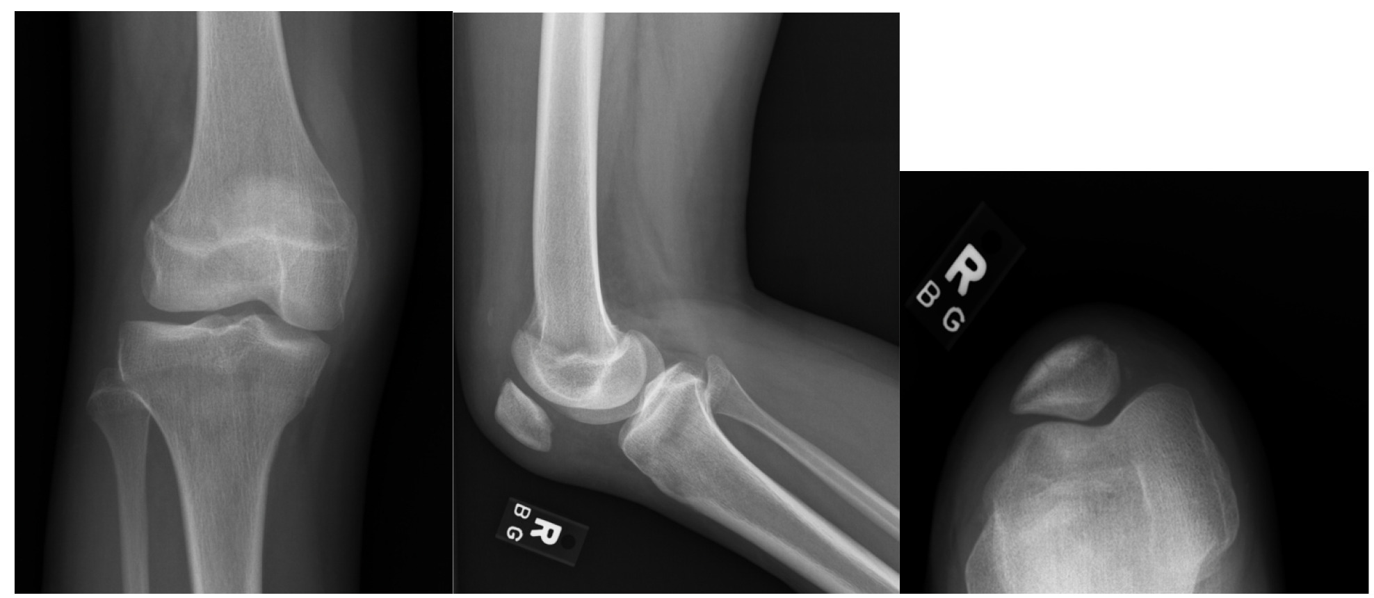 Irreducible lateral dislocation of the patella with vertical rotation ...