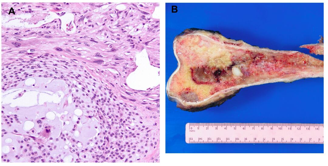 chondrosarcoma gross features