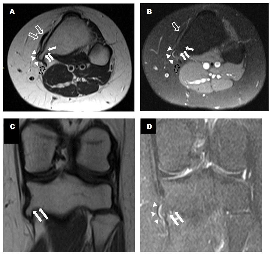 Medial Hamstring Snapping Knee Syndrome: Case Report of an Unusual ...