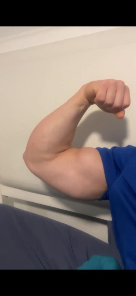 New reconstructive option in chronic distal biceps ruptures. A case ...