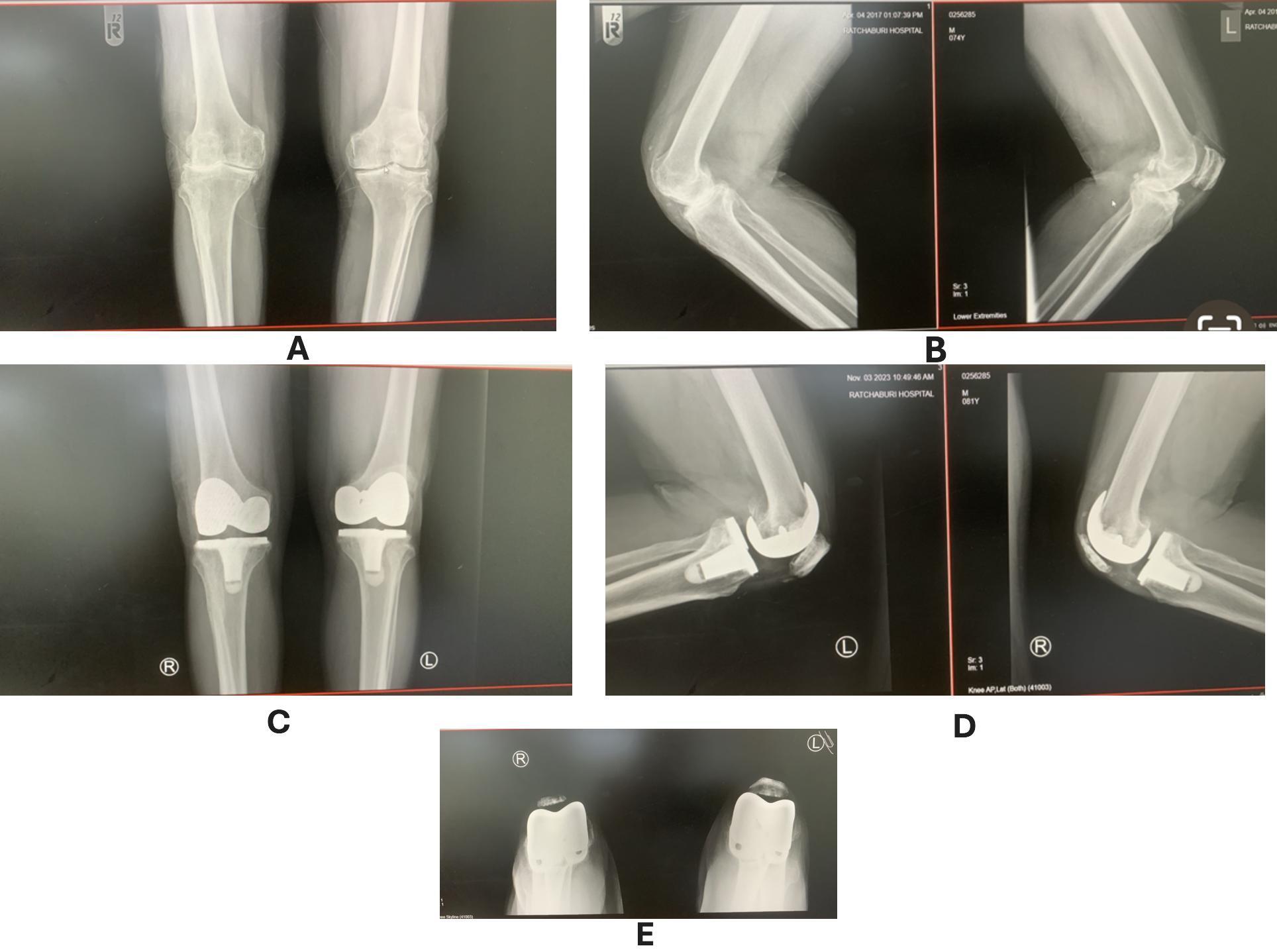 Primary total knee arthroplasty in a patient with a chronic total ...