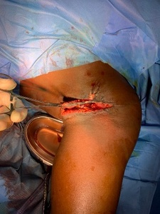 Axillary artery compression following reduction of a high-impact ...