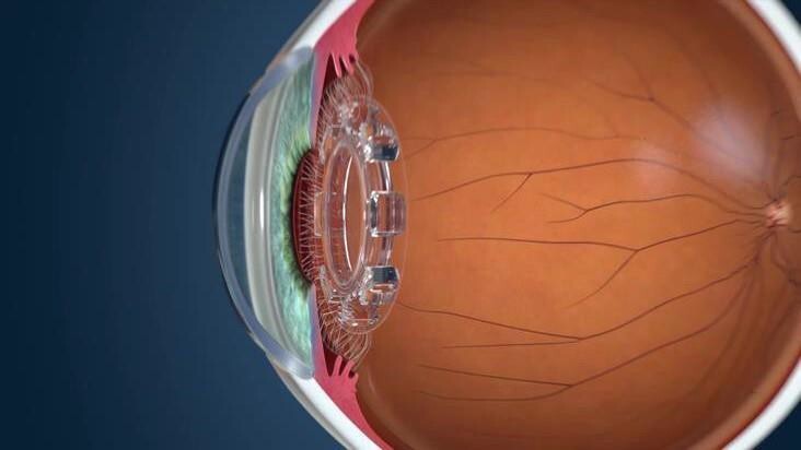 Refractive Surgery Overview | Published in CRO (Clinical & Refractive Optometry) Journal