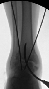 A New Technique For Tibiotalar Arthrodesis: Shotel Ankle Arthrodesis ...
