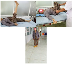 THE RETROSPECTIVE ANALYSIS OF TRIGEN INTERTAN NAIL IN THE TREATMENT OF ...