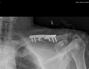 Managing Recurrent Clavicle Nonunion and Construct Failure: A Case ...