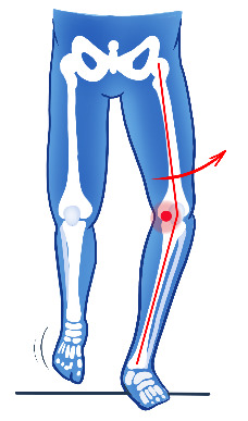 A New Paradigm in the Management of Knee Osteoarthritis and ...