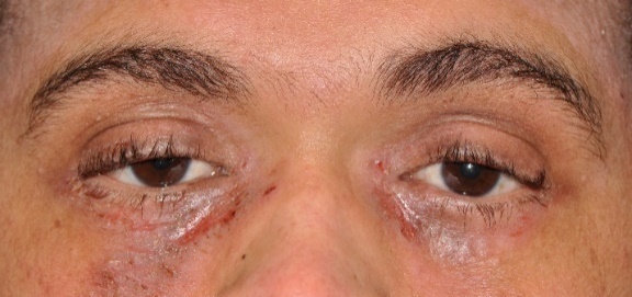Case Report of Corneal Ulceration Associated With Dupilumab | Published ...