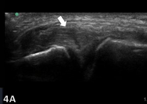 Diagnostic Musculoskeletal Ultrasound for Medial Collateral Ligament Injuries: Applications in ...