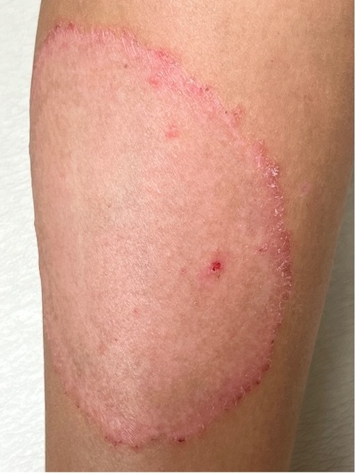 Tinea Corporis: Make the Diagnosis Before You Treat | Published in ...