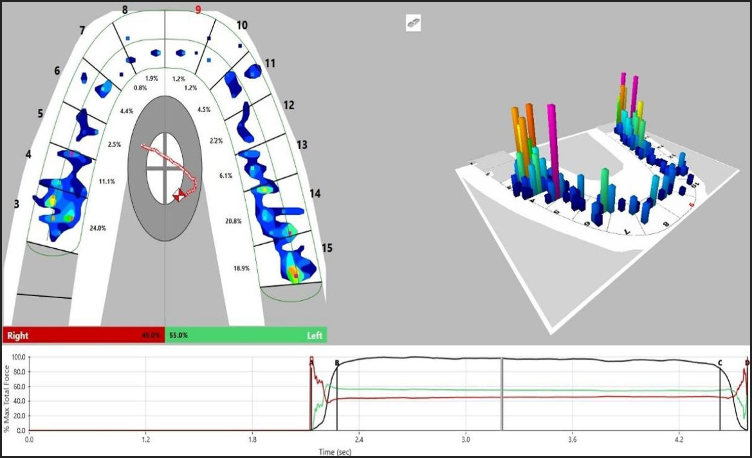 Digital Occlusion Analyzers: A Product Review of T-Scan 10 and ...