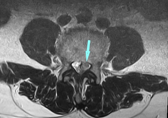 NON-SURGICAL CHIROPRACTIC MANAGEMENT OF A MASSIVE LUMBAR DISC EXTRUSION ...
