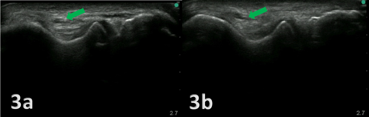 Utilizing Diagnostic Musculoskeletal Ultrasound in the Evaluation of ...