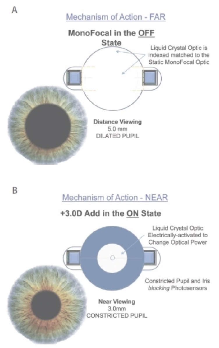 Refractive Surgery Overview | Published in CRO (Clinical & Refractive ...