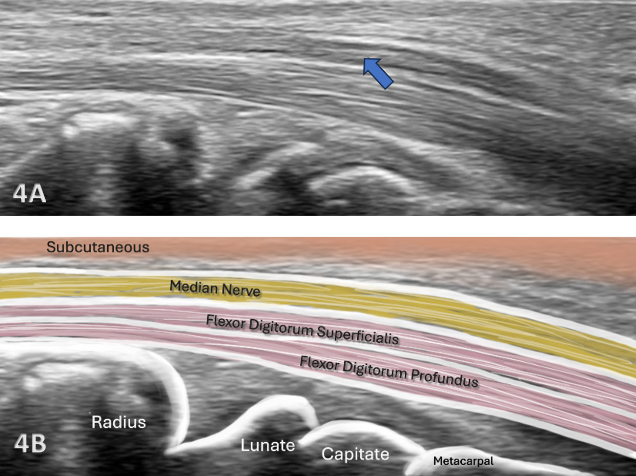 Diagnostic Musculoskeletal Ultrasound in the Evaluation of the Median ...