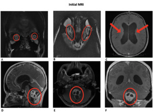 A Case Report of Papilledema Secondary to Hemangioblastoma | Published ...