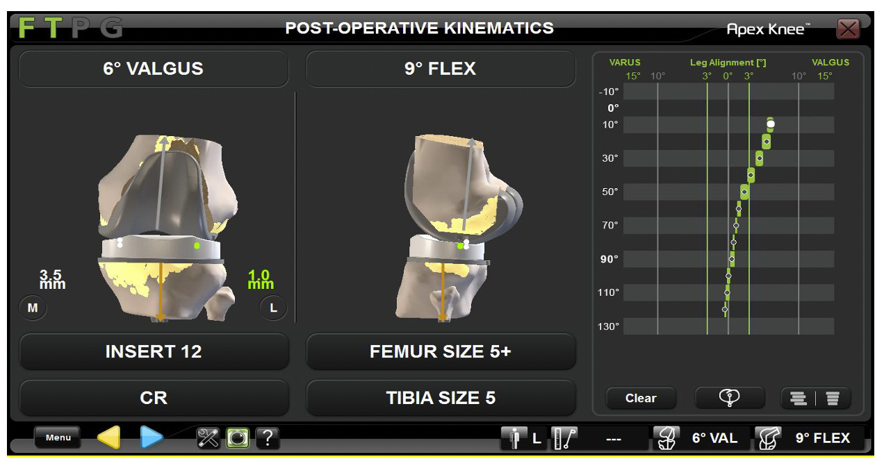 Total Knee Arthroplasty in Valgus Deformity Made Easy Using Robotic ...