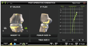 Total Knee Arthroplasty in Valgus Deformity Made Easy Using Robotic ...