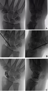 Volar Locking Plate Fixation for Scaphoid Fractures: Surgical Technique ...