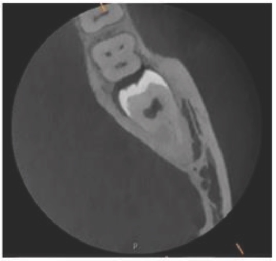 Coronectomy? A case report following coronectomy of a ‘high-risk ...