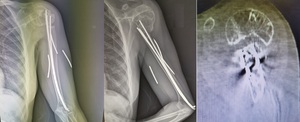 Salvage Reverse Shoulder Arthroplasty for Failed Proximal Humeral ...