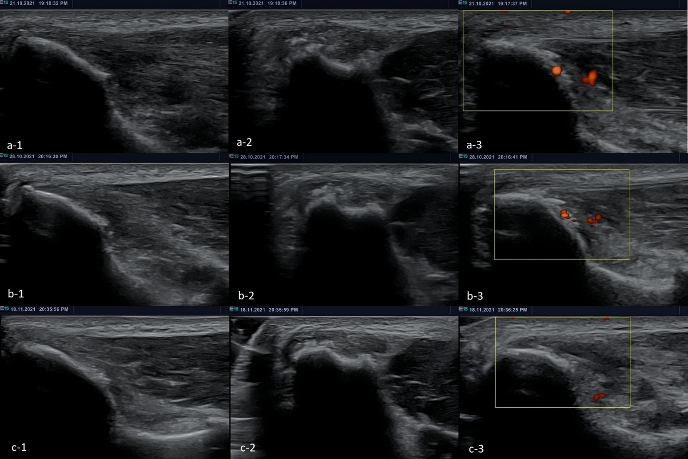 Current concepts of natural course and in management of medial ...