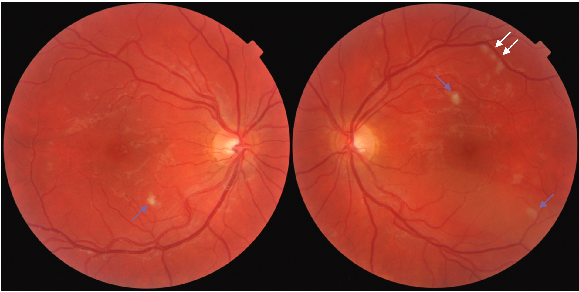 Case Report: Paracentral Acute Middle Maculopathy Associated with ...