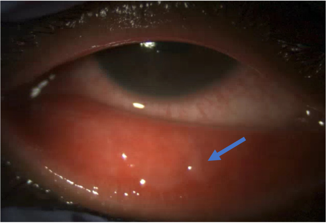 punctate keratitis ou