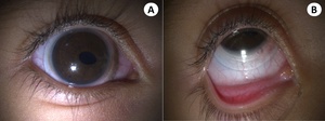 Management of Pediatric Open Globe Injury With Fenestrated Scleral Lens ...