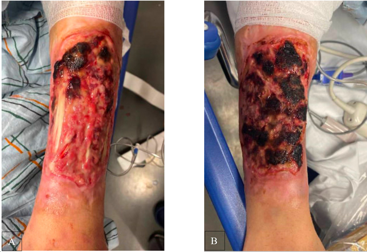 Xylazine Induced Skin Necrosis Emerging Public Health Crisis And The