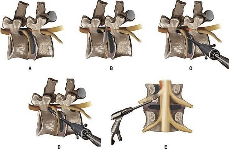 Interventional Therapy and Surgical Management of Lumbar Disc ...