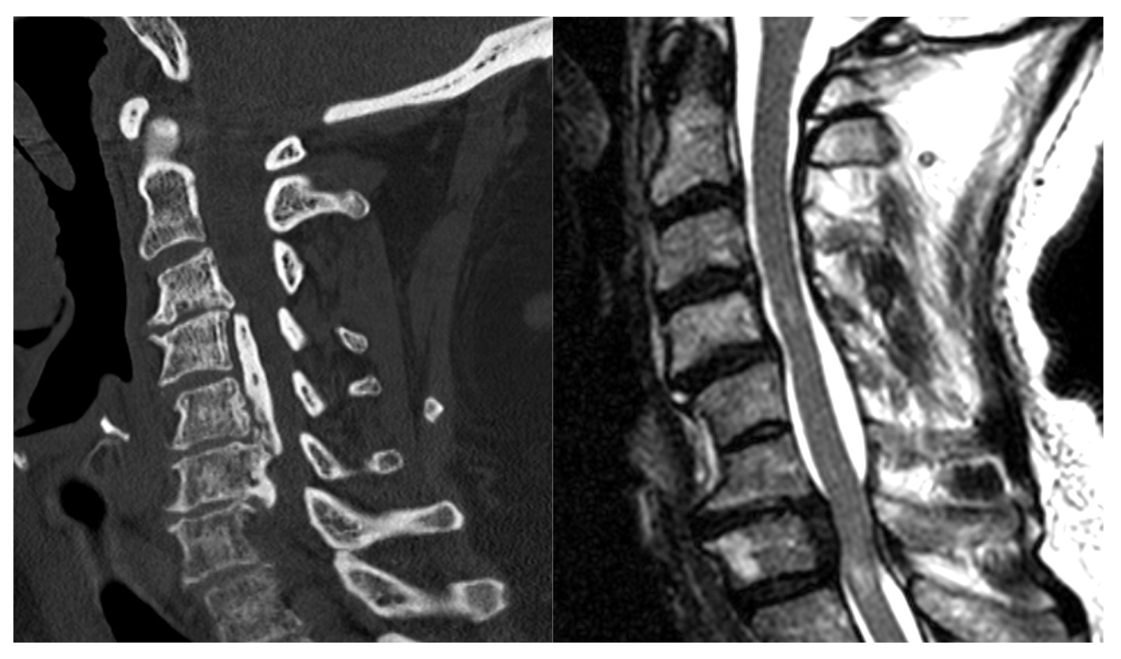 cervical myelogram