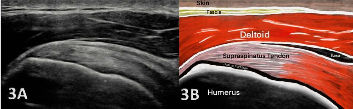The Application of Musculoskeletal Ultrasound in the Diagnosis of ...