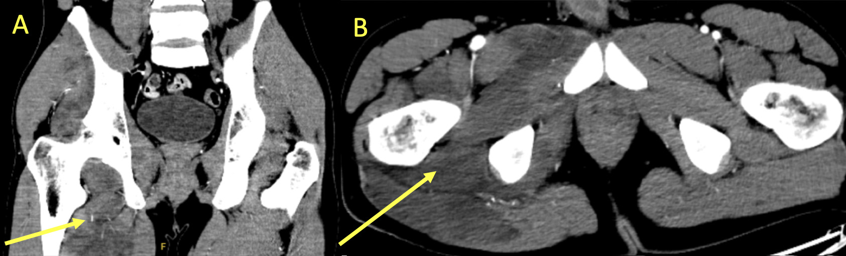 Atraumatic Unilateral Myositis with Rhabdomyolysis of the Right Lower ...