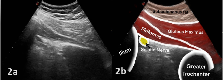 Use of Diagnostic Musculoskeletal Ultrasound in the Evaluation of ...