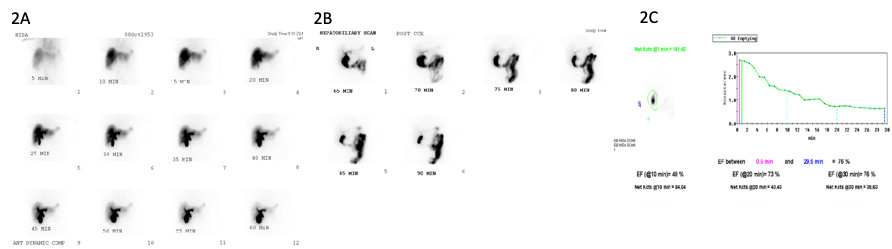 Biliary Dyskinesia with Reduced Gallbladder Ejection Fraction: A ...