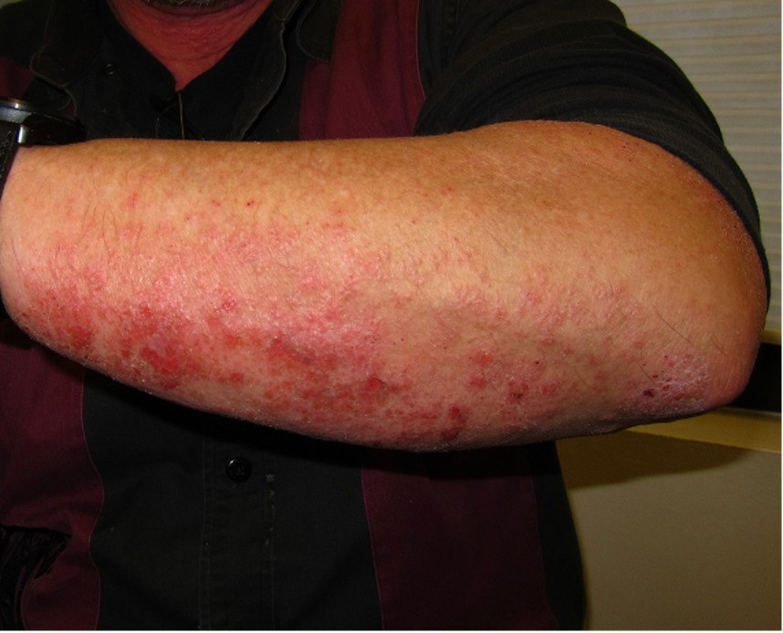 Chronic Actinic Dermatitis treatment with Dupilumab: A Case Report and ...