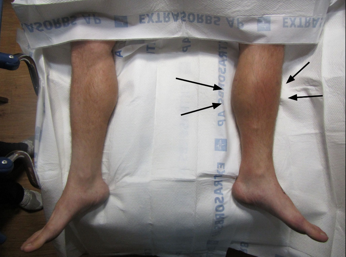 Deep Vein Thrombosis and Compartment Syndrome in an Intravenous Heroin ...