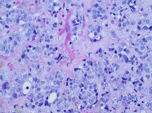 Acute Liver Failure from Infiltrative Metastatic Prostate Cancer: A ...