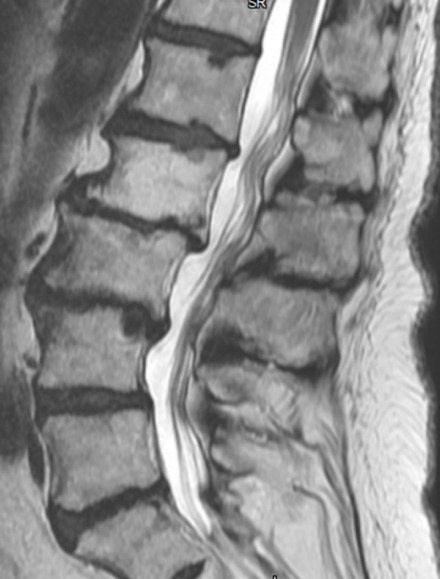 MANAGEMENT OF CHRONIC LOW BACK PAIN IN AN 80-YEAR-OLD FEMALE UTILIZING ...