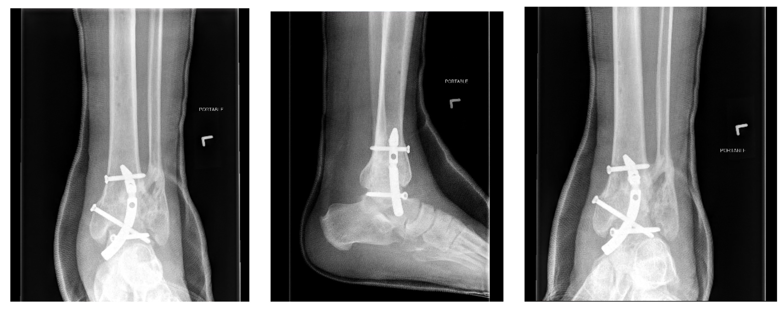 A New Technique For Tibiotalar Arthrodesis: Shotel Ankle Arthrodesis ...