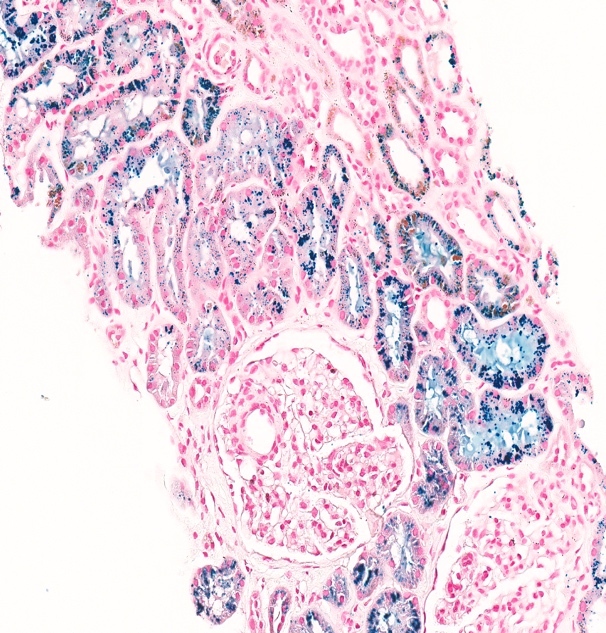 A Case of Renal Iron Overload Associated with Cold Agglutinin Disease ...