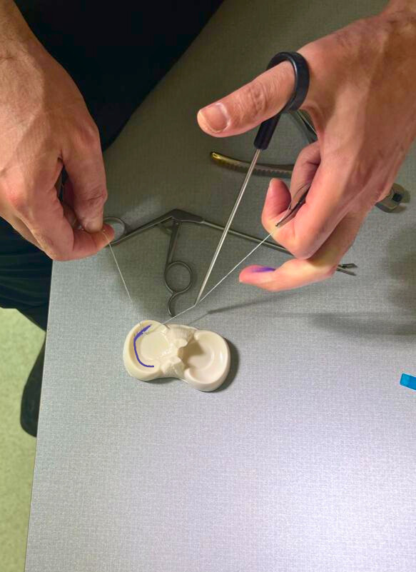 "Posteromedial Knee Incision for Combined Inside-Out and Outside-In ...