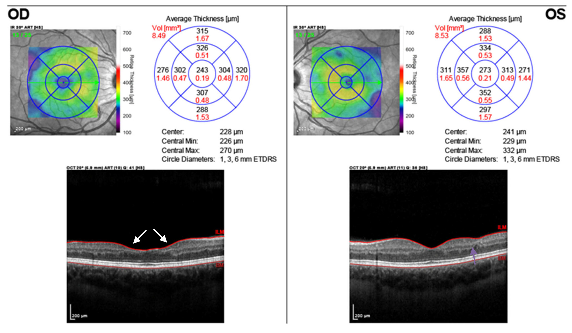 Case Report: Paracentral Acute Middle Maculopathy Associated with ...