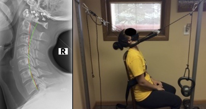 CHIROPRACTIC BIOPHYSICS MANAGEMENT OF STRAIGHT BACK SYNDROME AND ...
