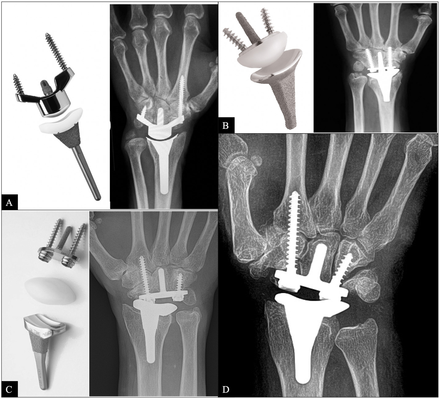 Surgical Wrist Implants Archway Orthopedics