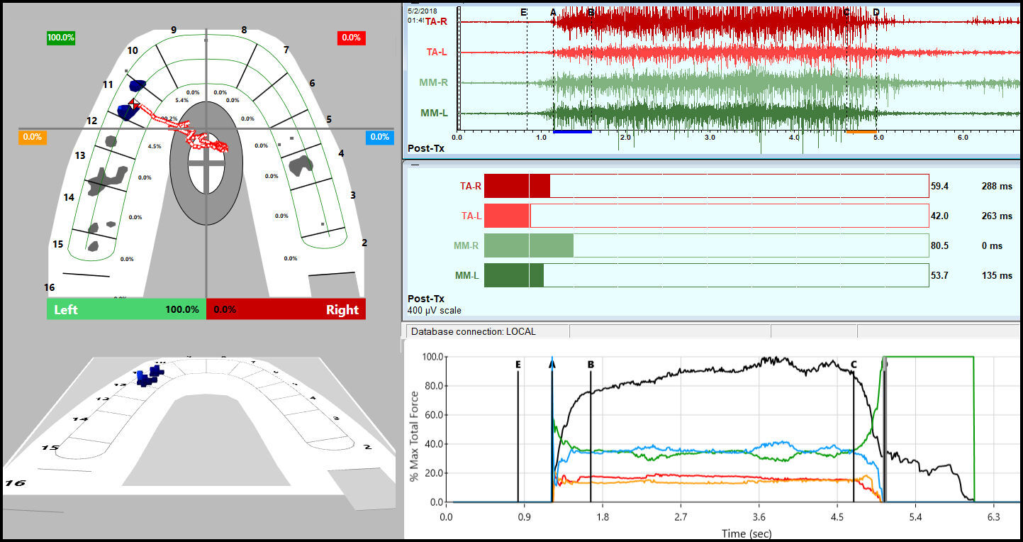 Digital evaluation of Occlusion in Treating a Patient Suffering from ...