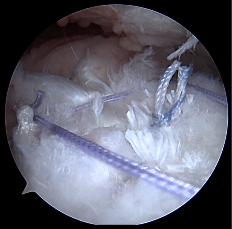 Anterior Cable Reconstruction Using Autologous Long Head of the Biceps ...