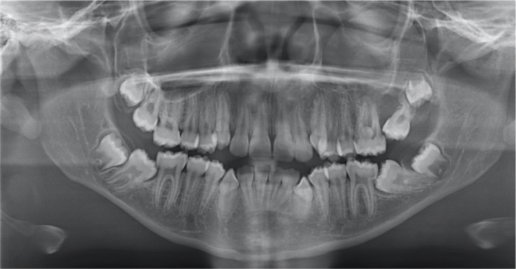 An inflammatory Odontogenic Cyst (Unusual Case): A case report ...